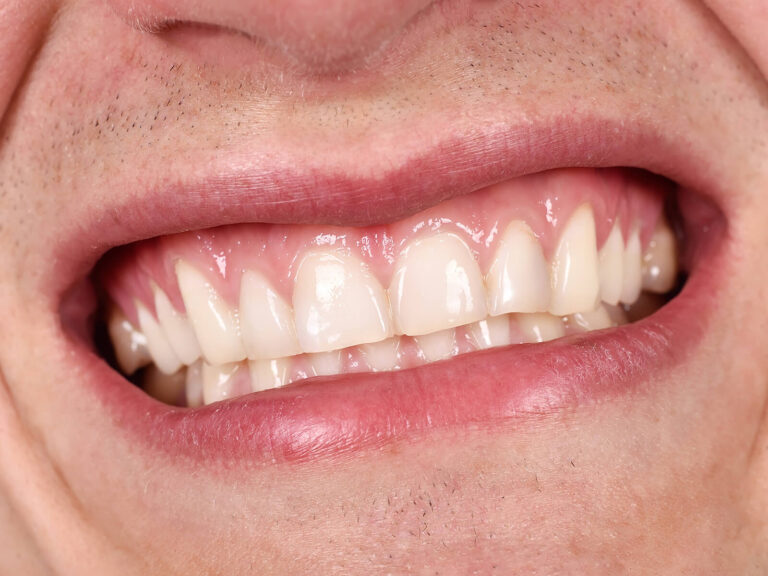 Treat your pale gums and eliminate all causes of white gums.